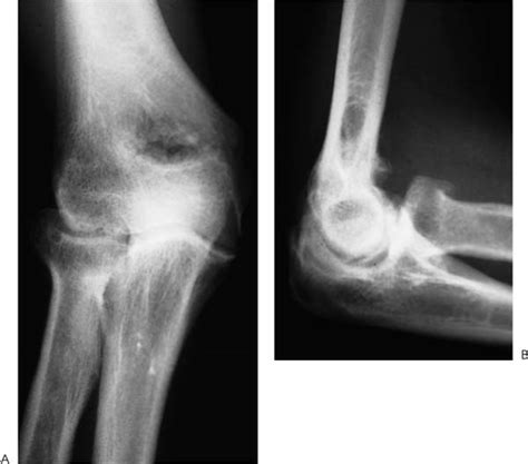 49 Radiocapitellar Arthritis Arthroscopic Versus Open Musculoskeletal Key