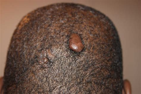 Scalp2 Keloid Removal Expert New York
