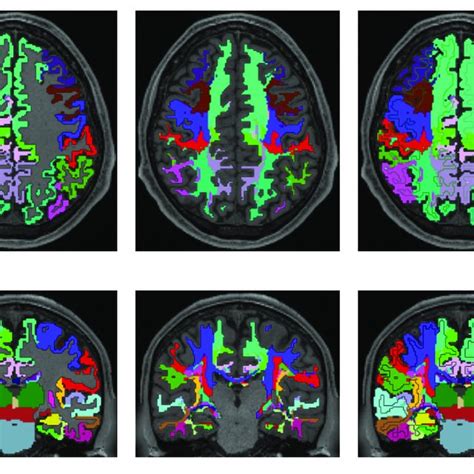 Comparison Of Cortex Parcellation With The Destrieux Atlas Gray Download Scientific Diagram
