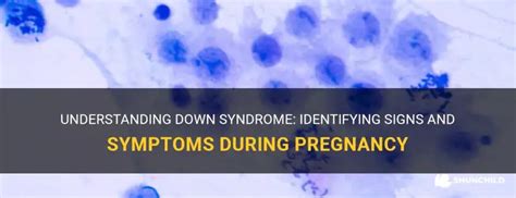 Understanding Down Syndrome Identifying Signs And Symptoms During