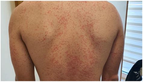 Cutaneous Side Effects Of Modern Targeted Therapy And Immunotherapy In Patients With