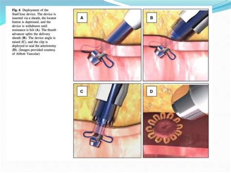 Vascular Closure Devices Pptx