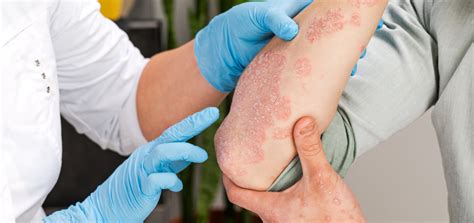 Find Psoriasis Medical Trials Near You Zackspace