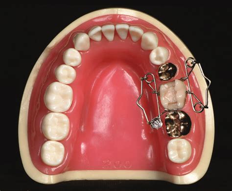 Walser Matrix O Type No 10 Used To Restore And Mod Cavity Preparation