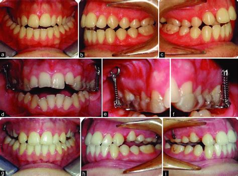 A C Pretreatment Intraoral Photos Presenting Maxillary Constriction Download Scientific