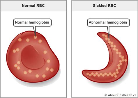 Sickle Cell Disease Understanding Its Impact