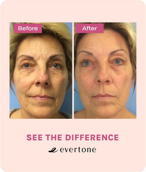Evertone Red Light Therapy Wand Evertone Skin