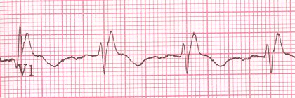Right Bundle Branch Block ECG Book
