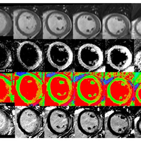 Cardiovascular Magnetic Resonance Findings In A Patient With Acute