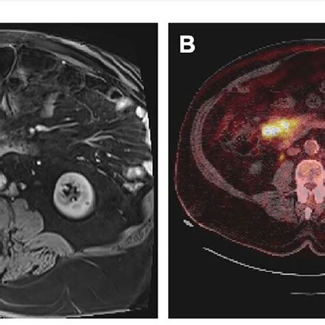 A E Deposits Along Peritoneal Ligaments A Falciform Download