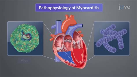 Video Myocarditis I Introduction