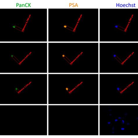 Detection Of Ctcs Captured By The Cellcollector® In Vivo System
