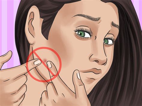 How To Get Rid Of A Zit Overnight With Pictures WikiHow