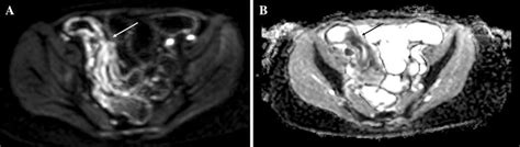 Stricture In The Terminal Ileum In A Patient That Lost Response To