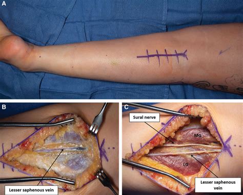 Combined Surgical Technique Of Hyperselective And Partial Motor Neurectomies For Spastic Equinus