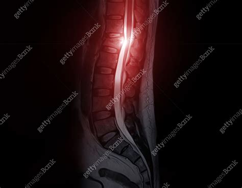 Mri Lumbar Spine Sagittal View 이미지 1412352177 게티이미지뱅크