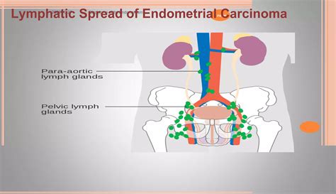 Carcinoma Endometrium Dr Hkcheema Professor Obgpims Jalandhar Pdf