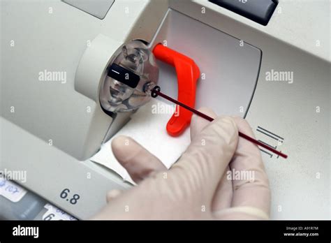 Specimen For Blood Gas Analysis At Victoria Wilsmore Blog