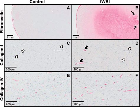 Fibronectin Produced By Cerebral Endothelial And Vascular Smooth Muscle Cells Contributes To
