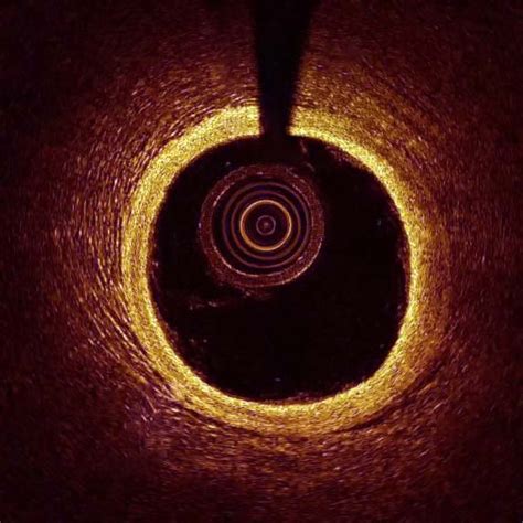 Identify Plaque During Endoscopy Using Intravenous Oct