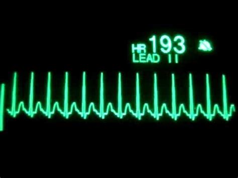 Taquicardia Supraventricular YouTube