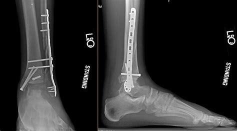 Dislocation Of The Proximal And Distal Tibiofibular 46 Off