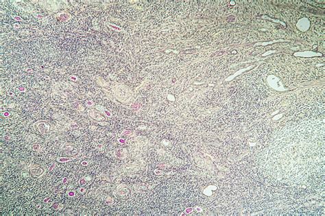 Hydronephrosis Background Images Hd Pictures And Wallpaper For Free