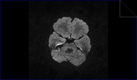 Pontine Glioma Diffuse Intrinsic Pontine Glioma Dipg