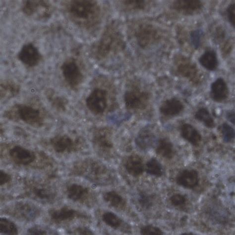 Photomicrograph Showing Midkine Expression In Moderate Epithelial