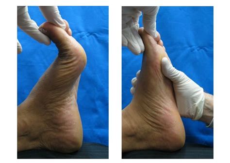 Hallux Limitus And The Vital Operation Of The First Mpj Hersco Edu Center
