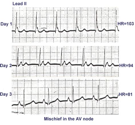 Ecg Learning Center An Introduction To Clinical Electrocardiography