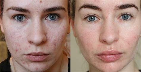 Roaccutane Month 3 Side Effects My Skin Now Katie Snooks