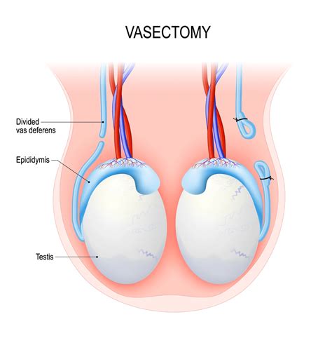 Vasectomy Orgasm Clearance Vivatumusica