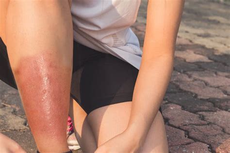 Celulitis Archivos Idermapp Tu App De Dermatología