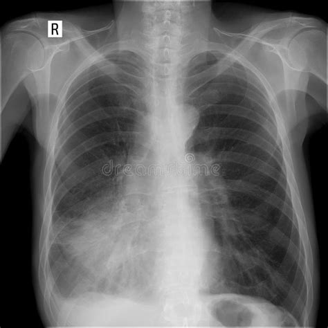 X Ray Lung Showing A Large Infiltrate In The Middle Lobe Of The Right Lung Pneumonia Stock