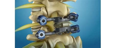 Premia Spine Launches Fda Approved Tops™ System At North American Spine