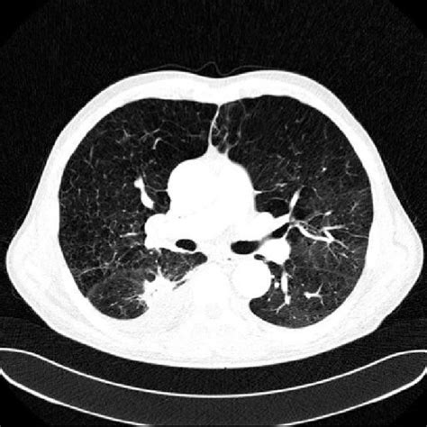 Axial Ct Image Lung Window Shows A Spiculated Nodule In The Sixth