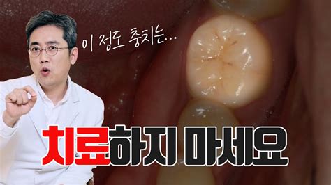 충치 치료때문에 고민이신 분들은 보세요 치과에서 바가지 안 쓰는 법 충치치료 초기충치 신경치료 Youtube