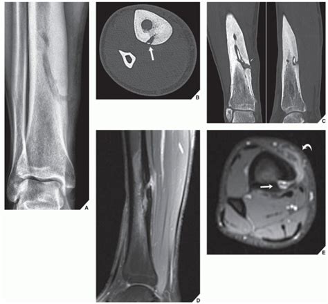 Osteomyelitis Infectious Arthritis And Soft Tissue Infections Radiology Key