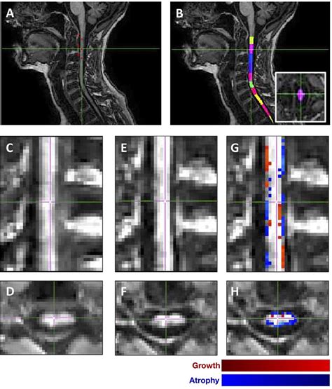 Spinal Cord Segmentation And Generalized Boundary Shift Integral