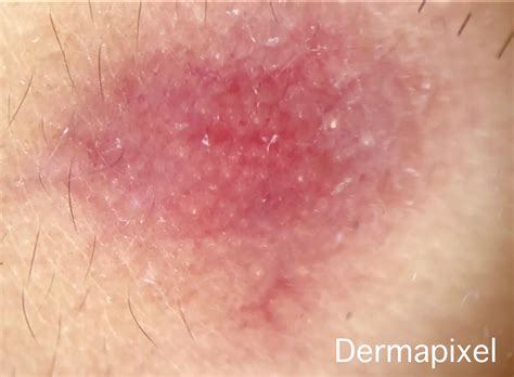 Dermapixel Granuloma aséptico facial idiopático GAFI Con mi nombre