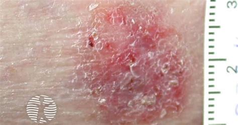 Basal Cell Carcinoma Image