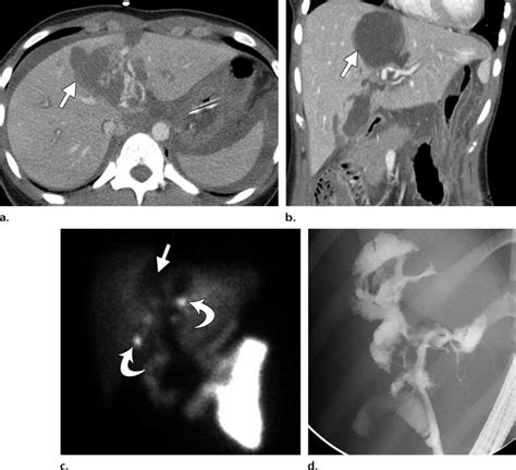 Bilomas In A 43 Year Old Woman Who Was An Unrestrained Passenger And