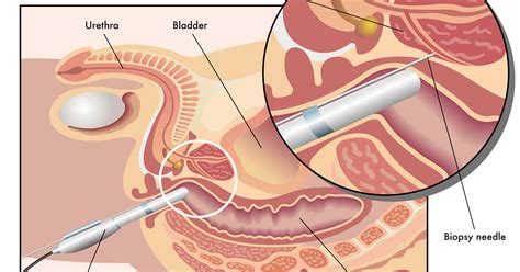 Prostate Biopsy Procedure Cls Health