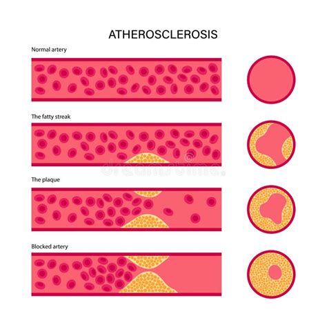 Cholesterin Und Atherosklerose Vektor Abbildung Illustration Von