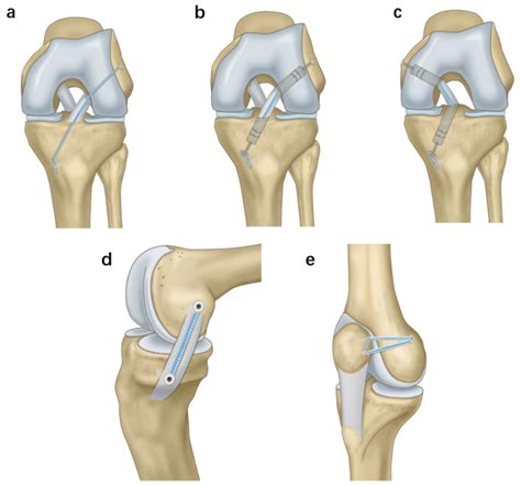 Surgical Model Of Internal Brace Technique In Knee Ligament Injuries