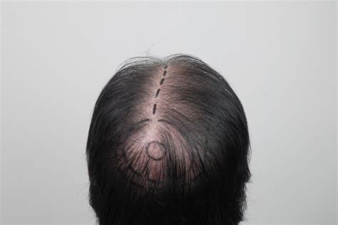 [글로웰의원] 정수리 혼합 모발이식 두피문신 모발이식 후기 리뷰 비용은 대다모