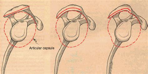 Shoulder Impingement Syndromes Dynamic Chiropractic