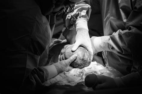 C Section Surgery Procedure Steps