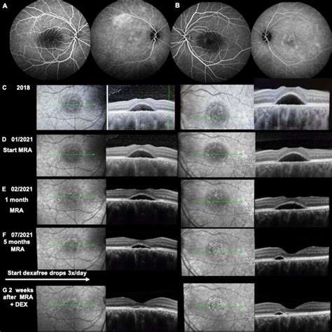 Multimodal Imaging Of A 32 Year Old Woman With Bilateral Chronic Cscr